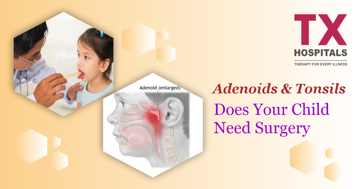 Adenoids and Tonsils: Does Your Child Need Surgery?